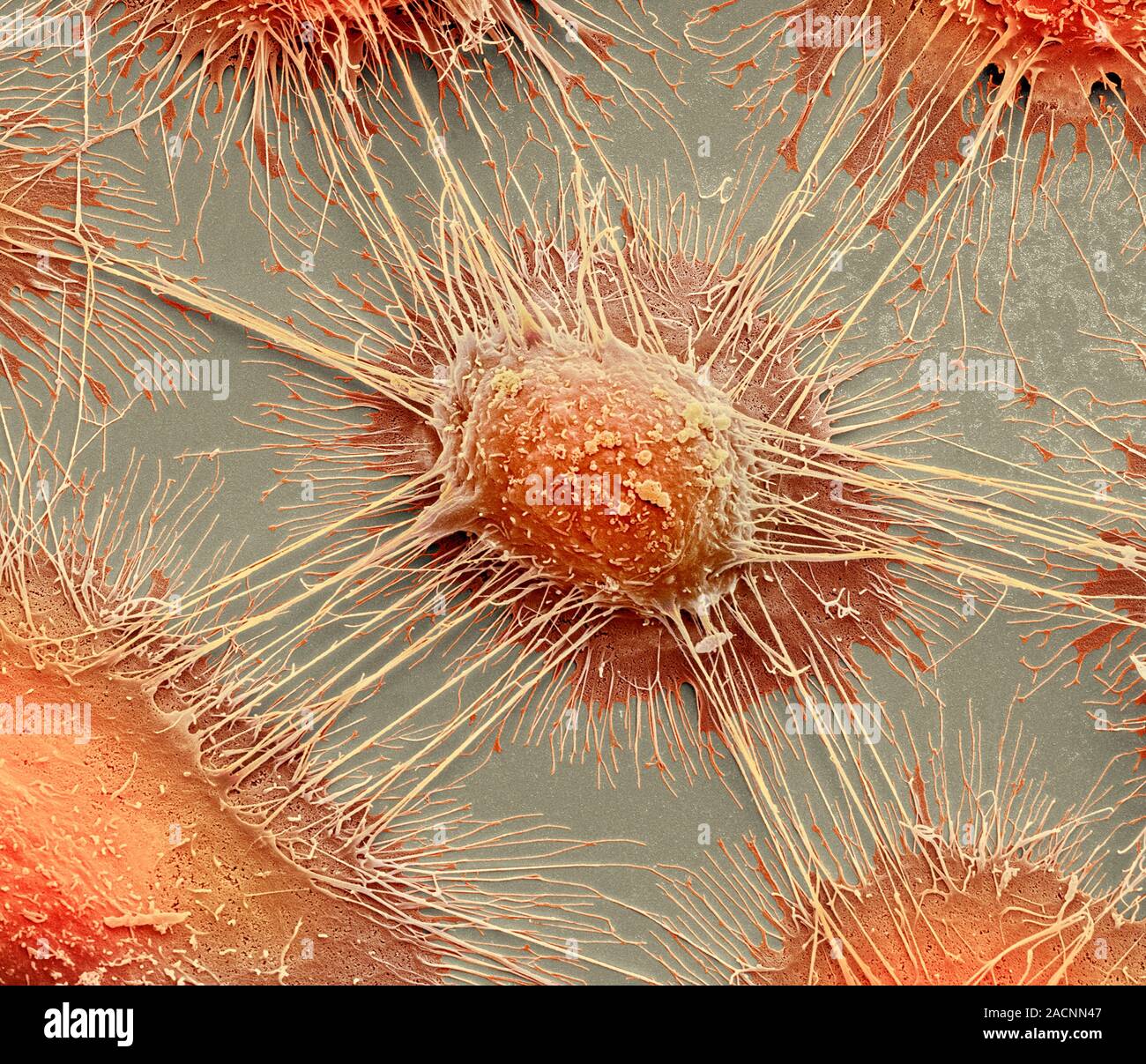 Mouth cancer cells. Coloured scanning electron micrograph (SEM) of ...
