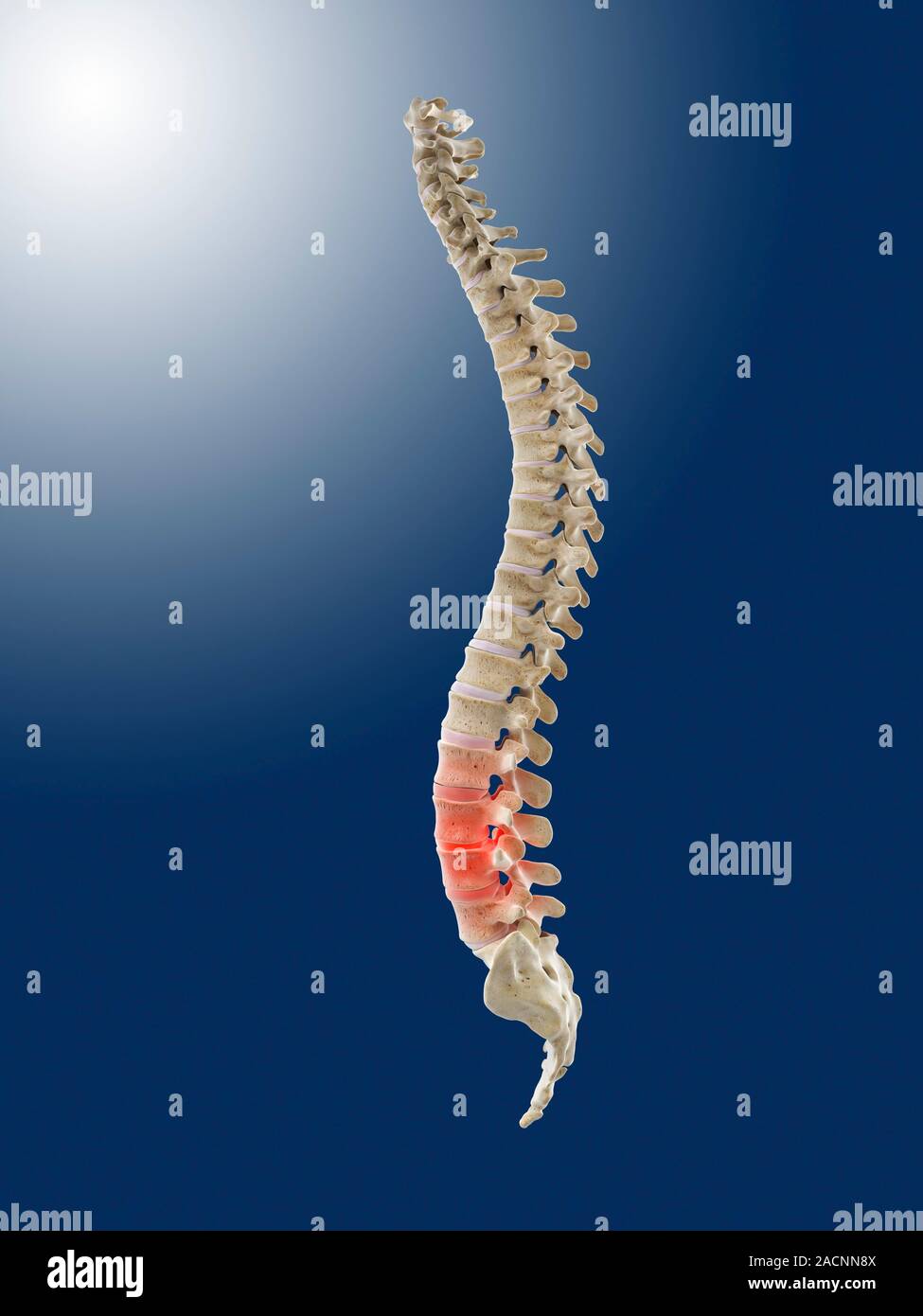 Lower back pain, conceptual computer artwork. Inflammation (red) in the ...
