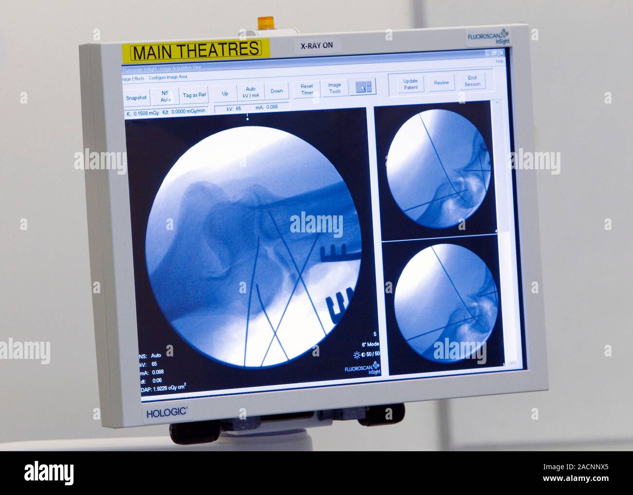 Arm fracture surgery. Screen showing X-rays of a patient's elbow during ...