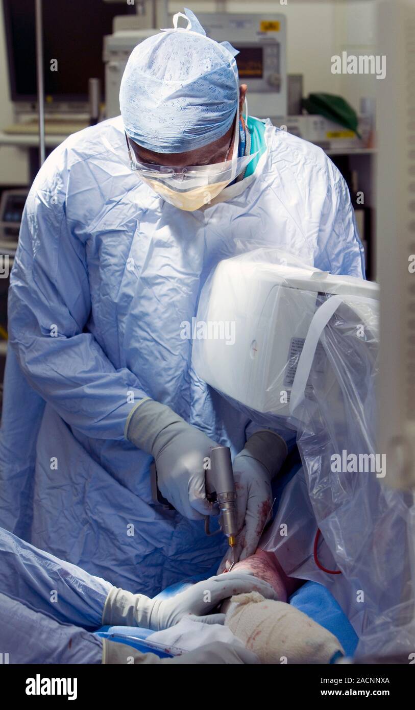 Arm fracture surgery. Surgeon operating on a patient during surgery to ...