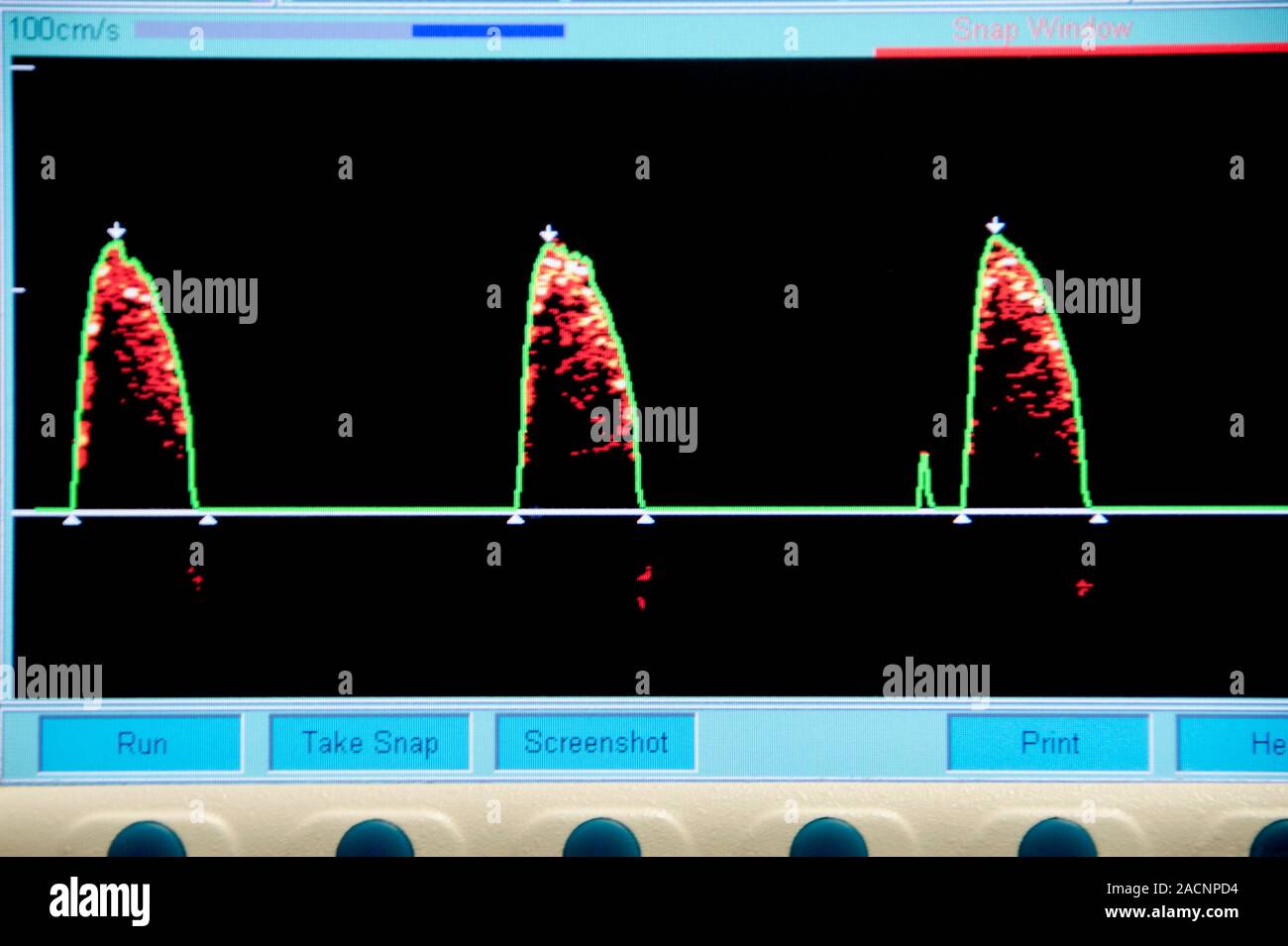 Oesophageal doppler blood flow monitor. Display showing readings for ...