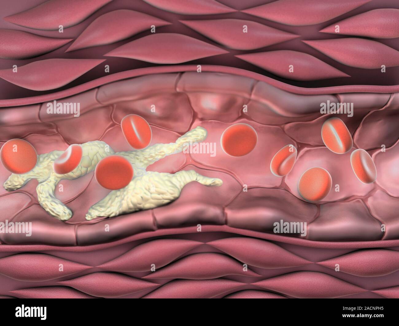 Narrowed artery. Computer artwork of a section through an artery ...