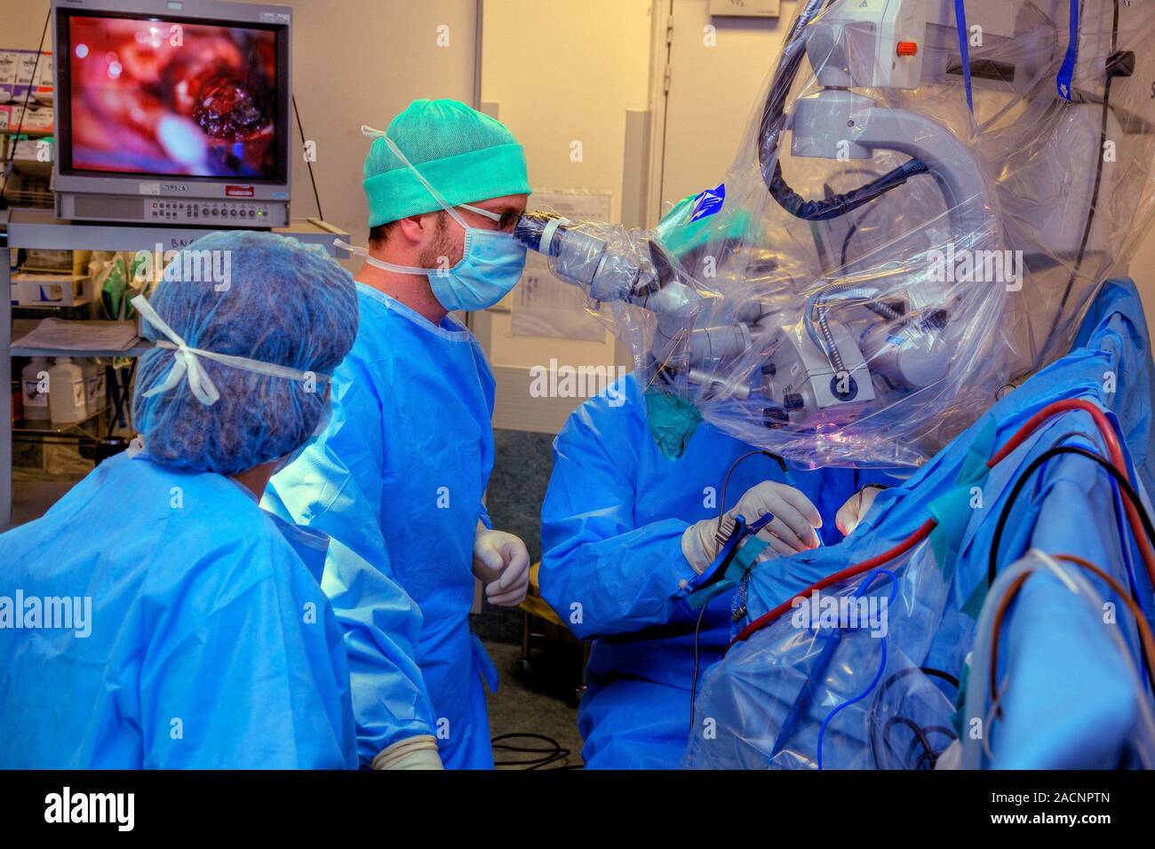 Brain surgery. Surgeons removing a tumour from a patient's brain ...