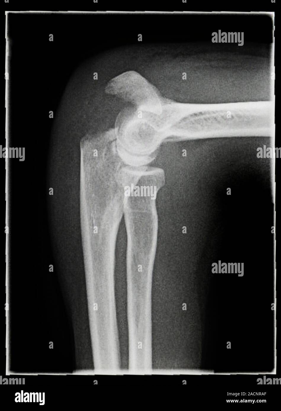 Broken elbow. X-ray of a posterior fracture-dislocation (upper left) of ...