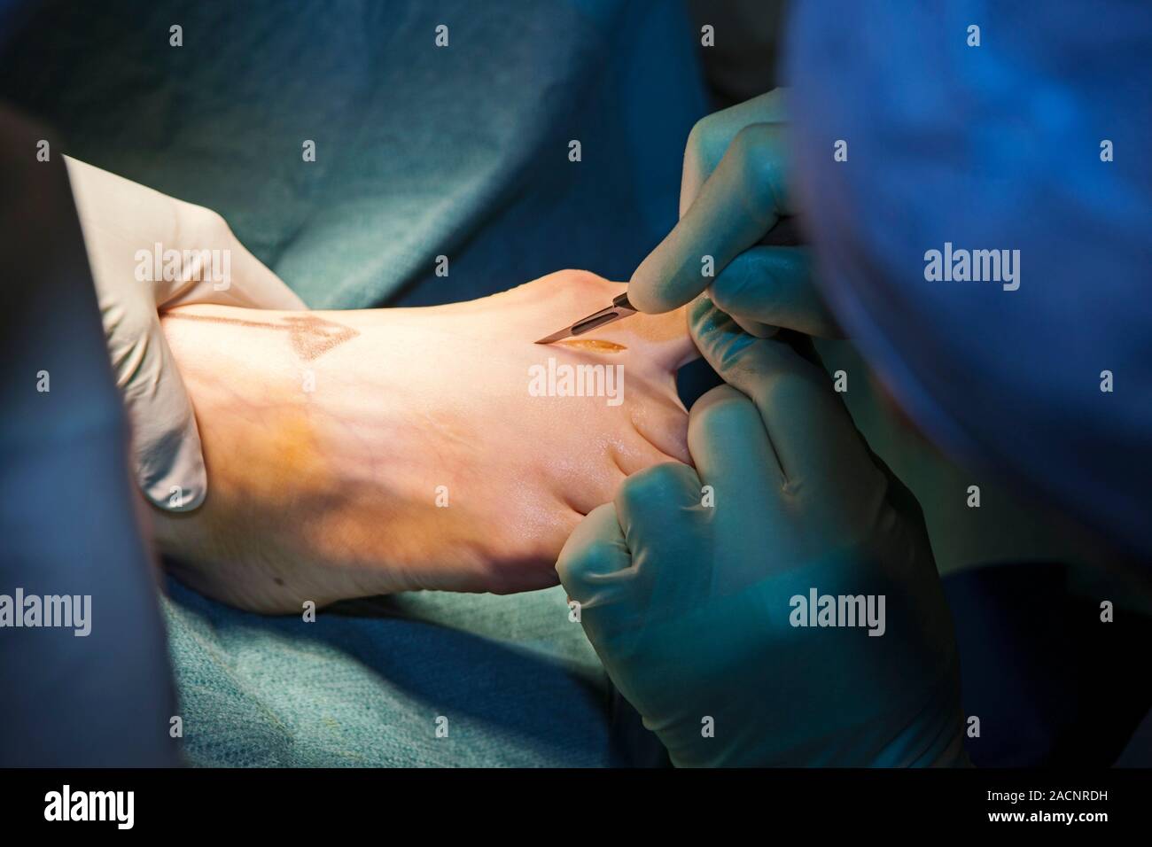 Bunion surgery. Close-up of surgeons carrying out the initial incision ...