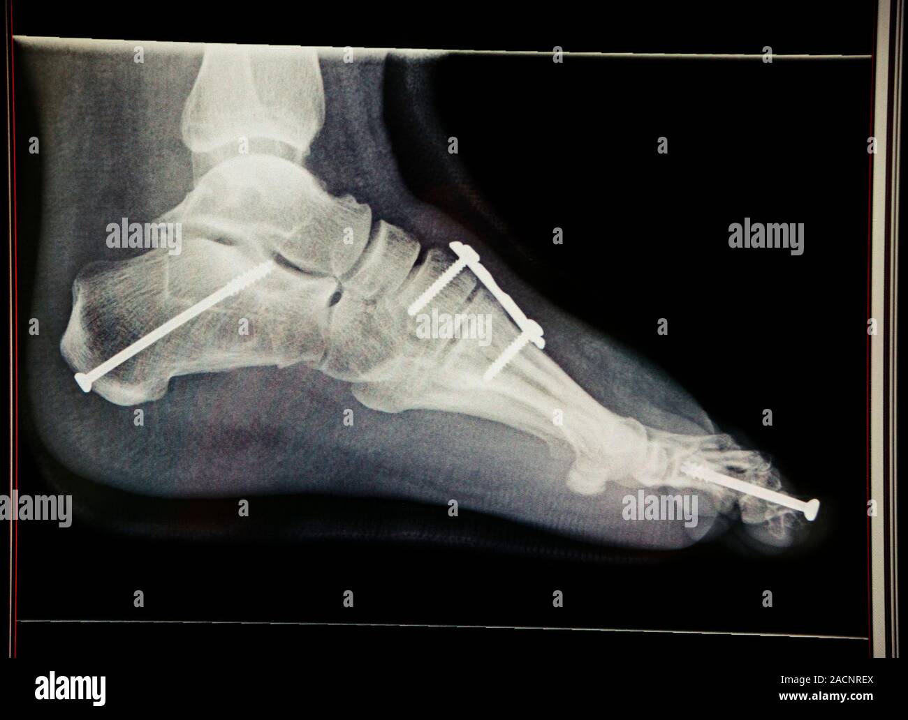 Pinned foot bones after surgery. Lateral (side view) X-ray showing pins ...