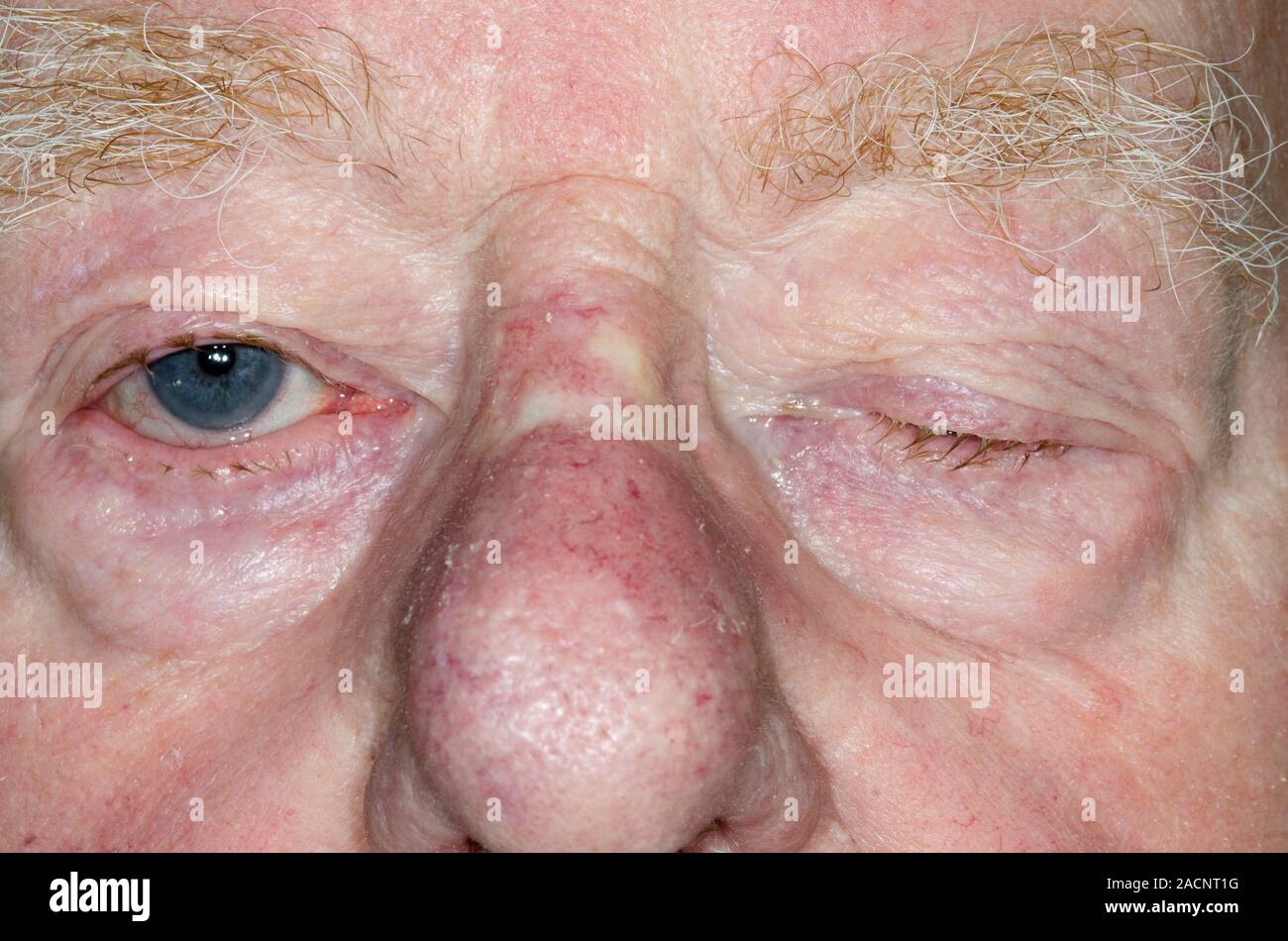 Drooping eyelid (ptosis) in an 89 year old male patient following a ...