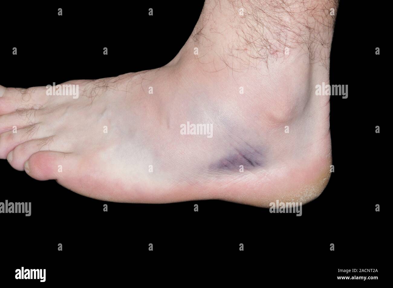 Swelling and bruising (haematoma) of a sprained ankle in a 37 year old ...