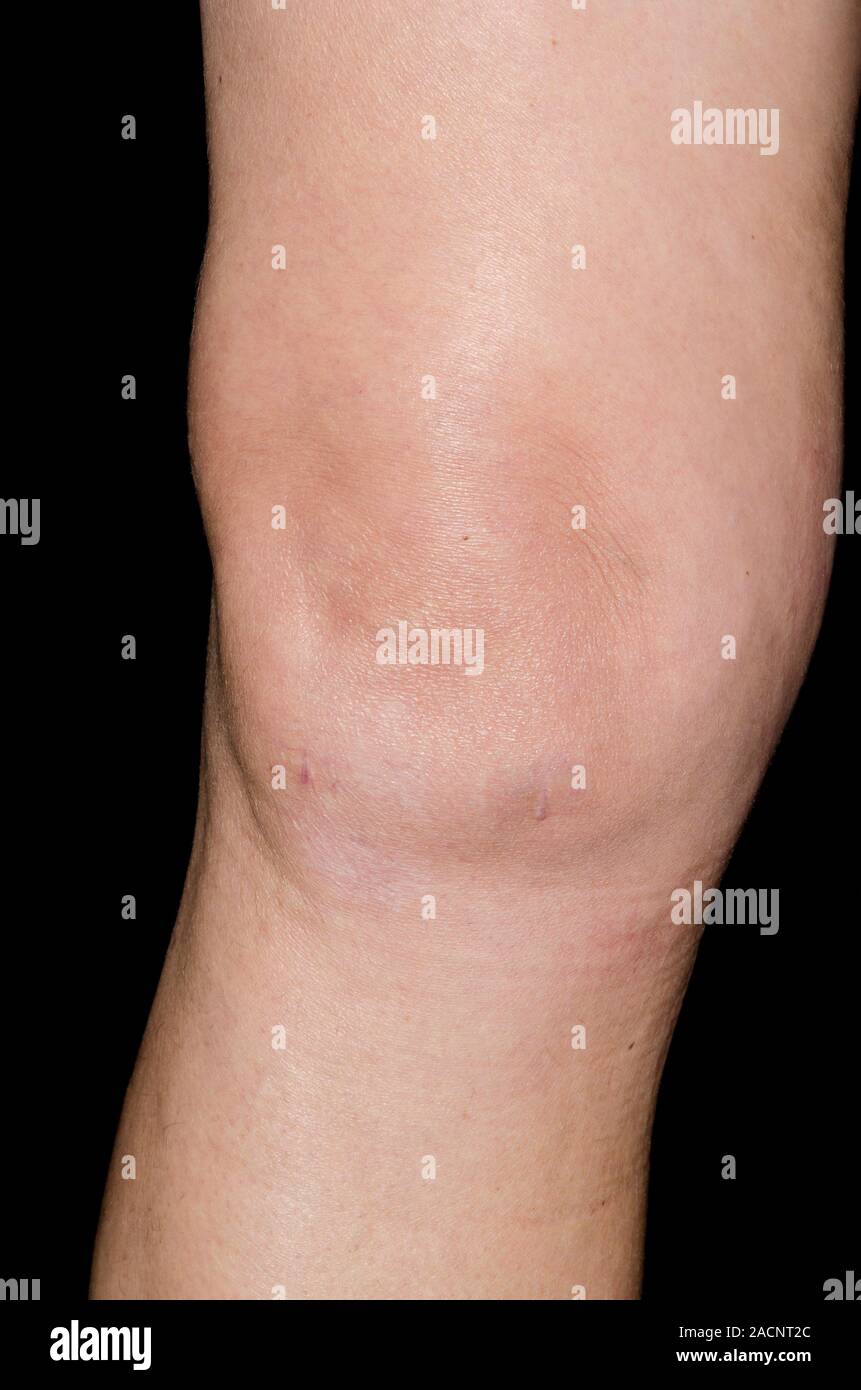 Swelling of the knee with effusion (fluid in the joint) in a 50 year ...