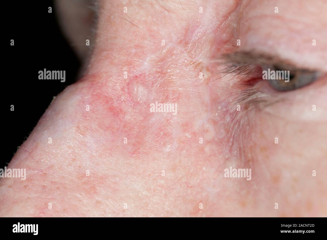 Close-up of the scar following an excised (surgically removed) skin ...