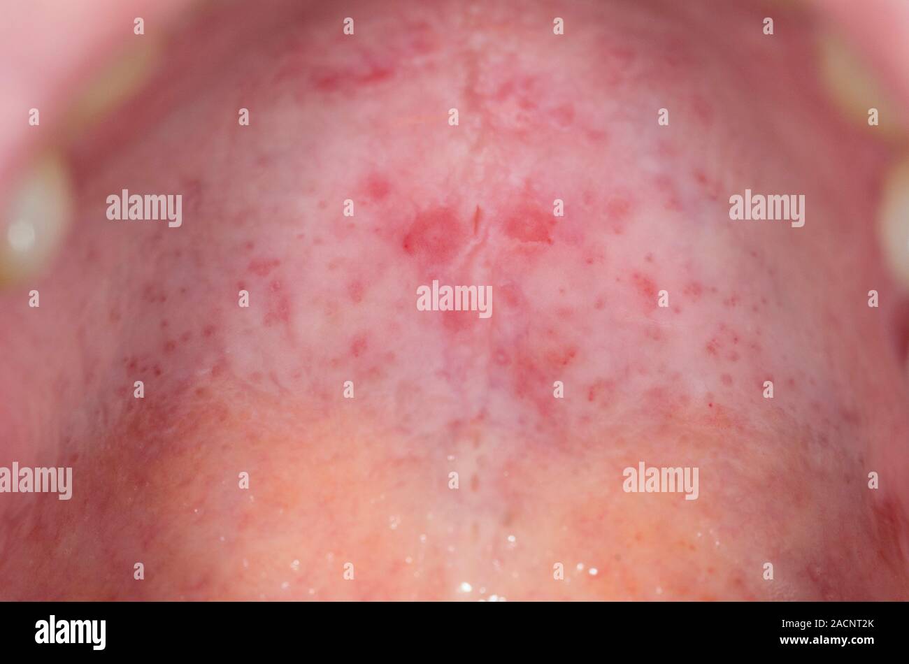 Close Up Of Lesions On The Palate Of The Mouth In A 41 Year Old Male Patient With Hand Foot And