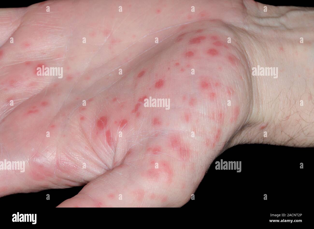 Lesions on the hand in a 41 year old male patient with hand foot and ...