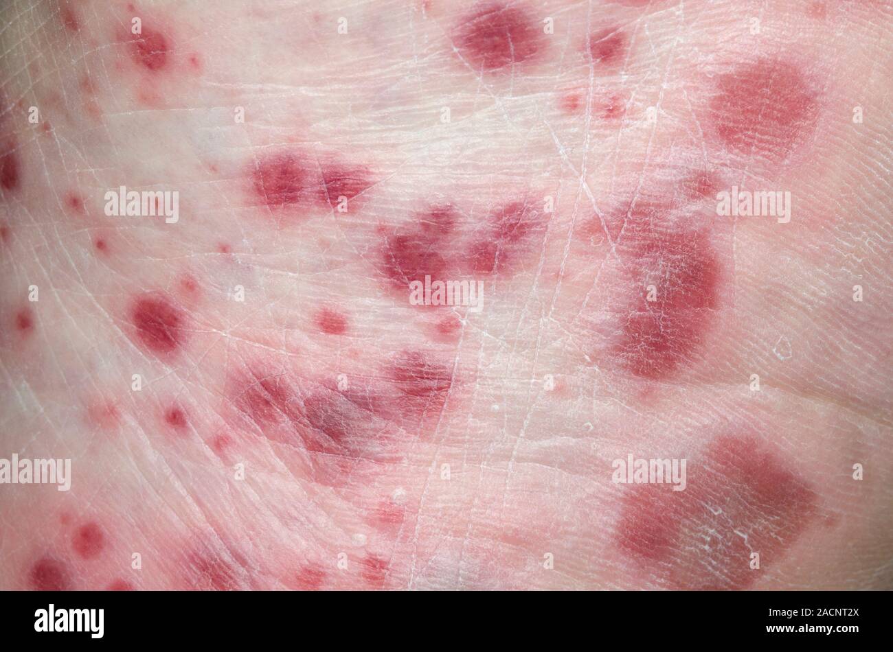 Close-up of lesions under the foot in a 41 year old male patient with ...