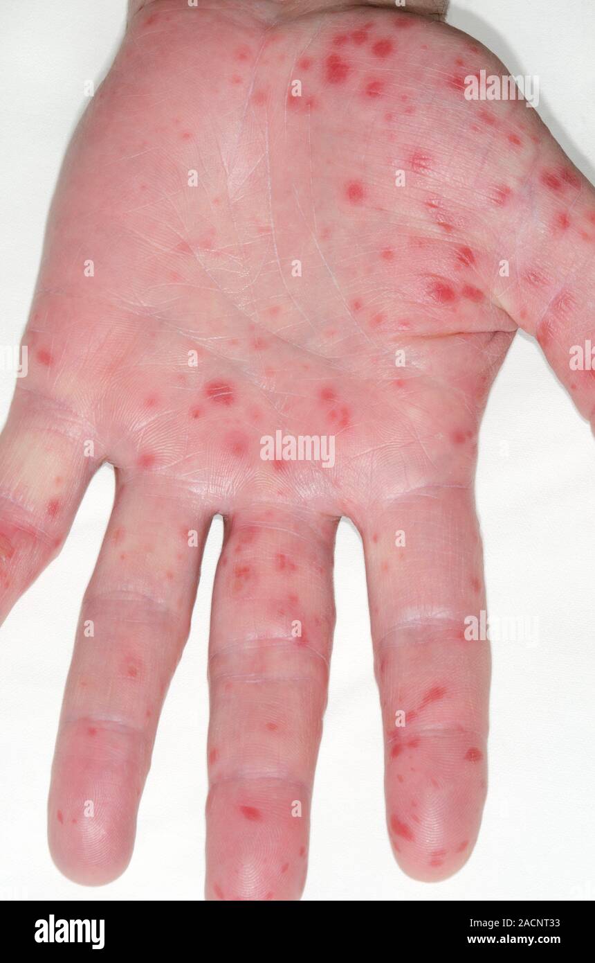 Lesions on the hand in a 41 year old male patient with hand foot and ...