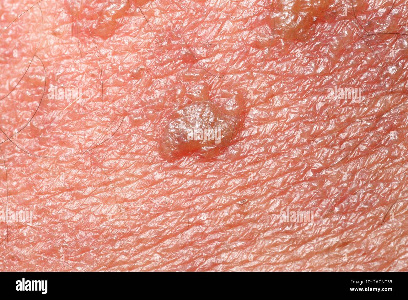 Close-up of lesions from a shingles rash on the back in a 73 year old ...