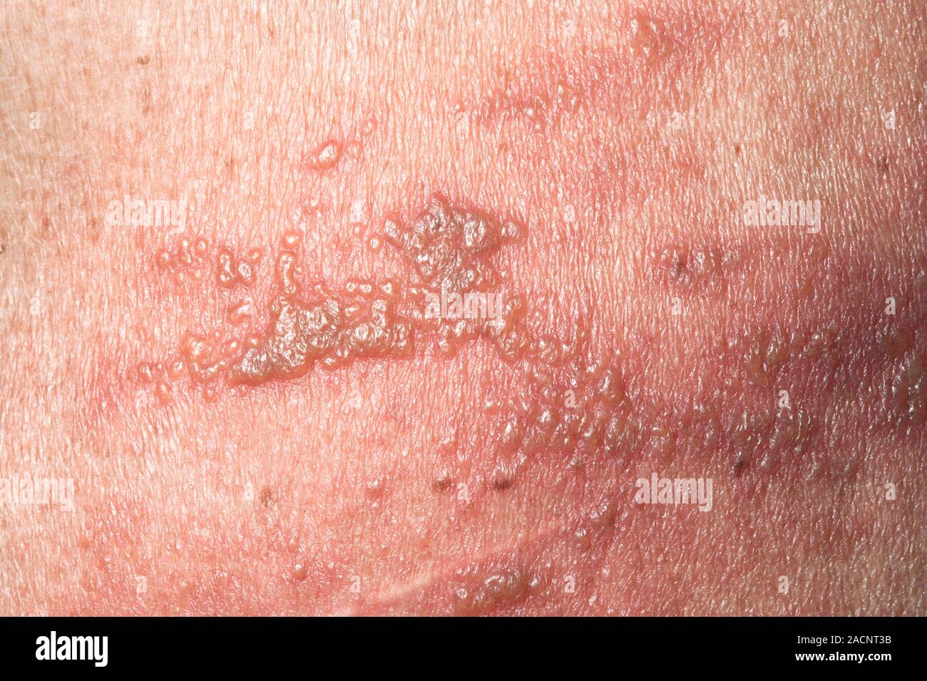 Close-up of lesions from a shingles rash on the back in a 73 year old ...