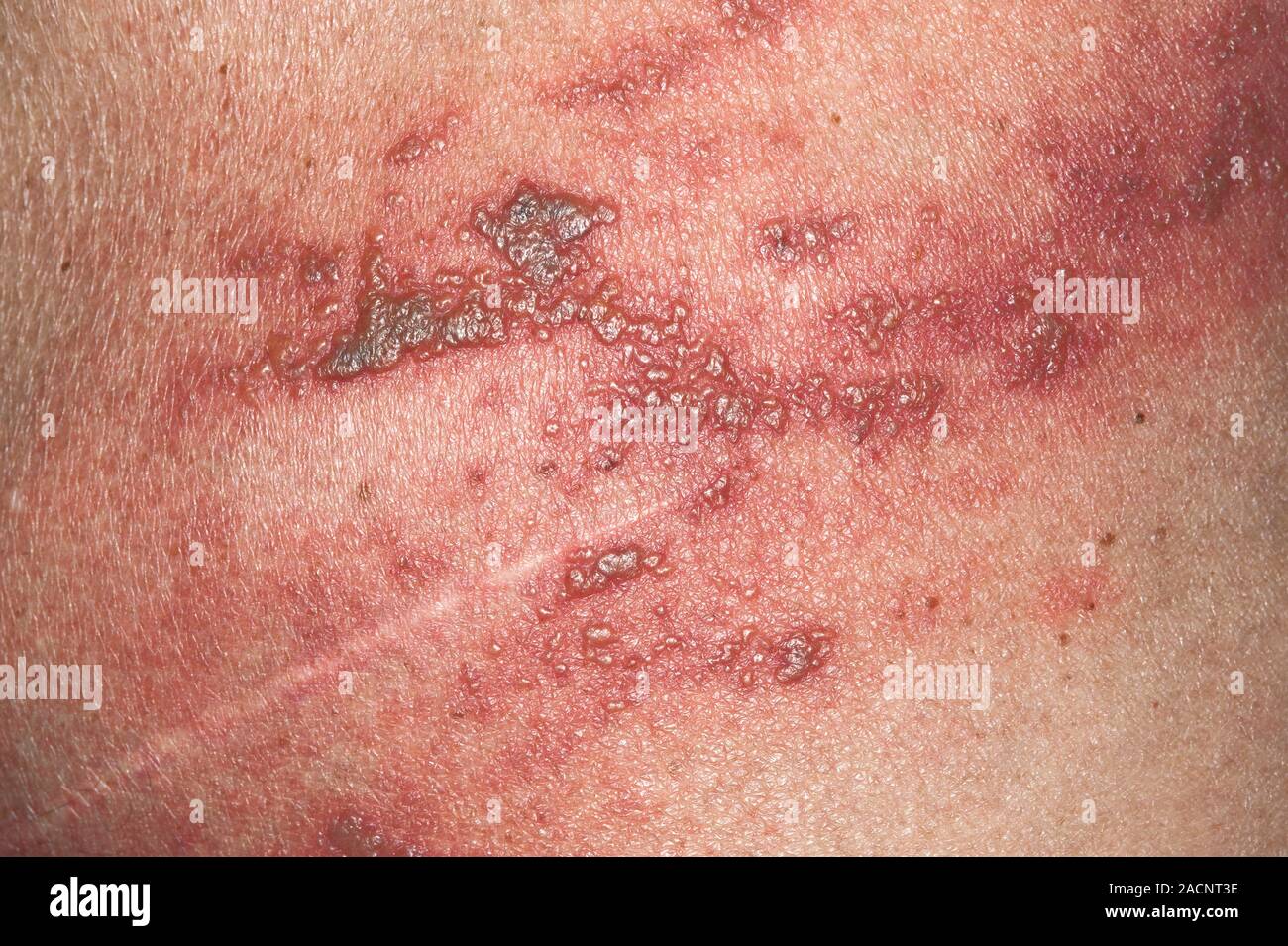 Close-up of lesions from a shingles rash on the back in a 73 year old ...