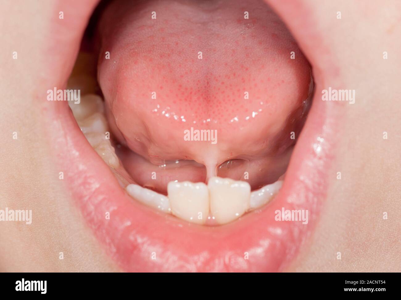 Close Up Of Tongue Tie Ankyloglossia In A 7 Year Old Male Patient In Which The Frenulum