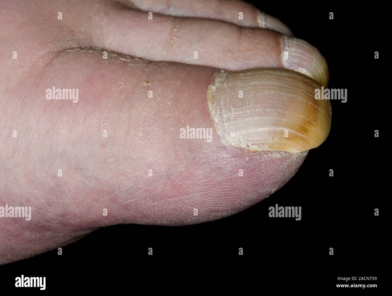 Close-up of toenails showing clubbing (beaking) in a 64 year old male ... Close-up of toenails showing clubbing (beaking) in a 64 year old male ...