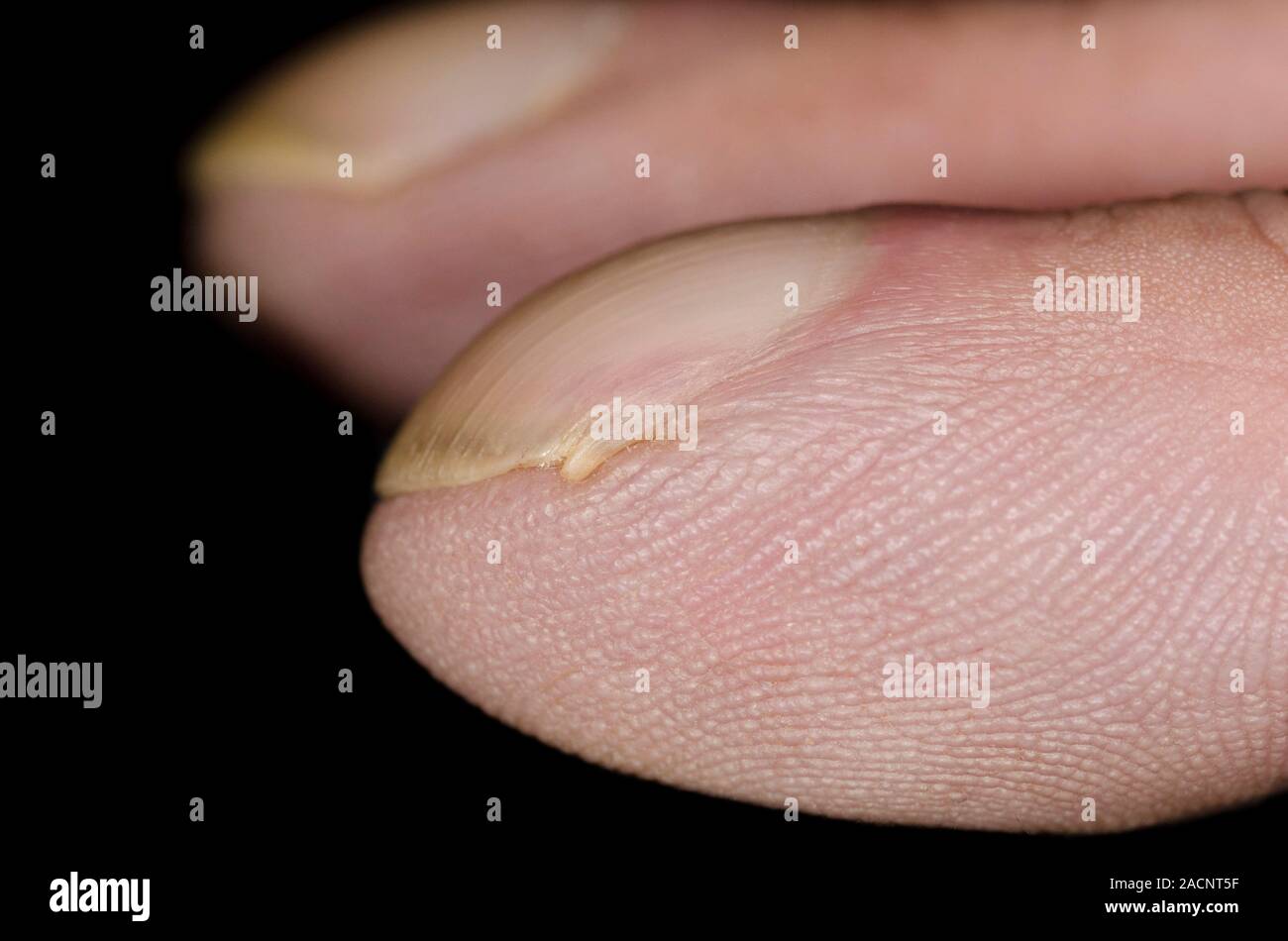 Close-up of toenails showing clubbing (beaking) in a 64 year old male ... Close-up of toenails showing clubbing (beaking) in a 64 year old male ...