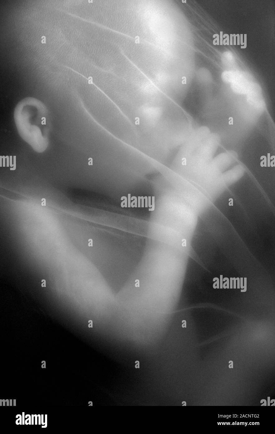 Human foetus in the womb. 19-week-old human foetus sucking its thumb in ...