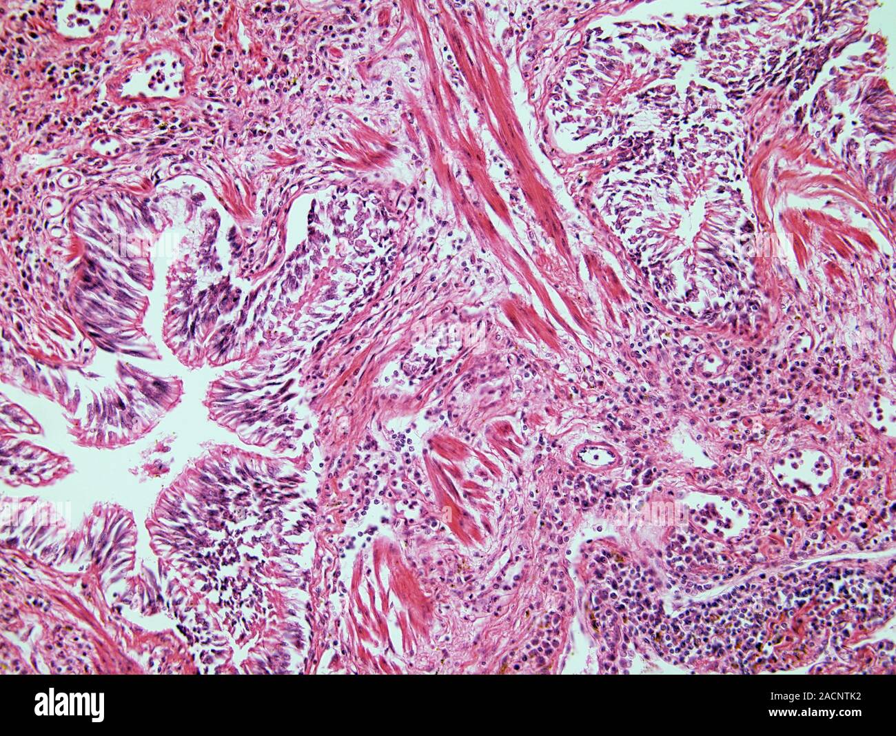 Lung cancer. Light micrograph of a section through lung tissue affected ...