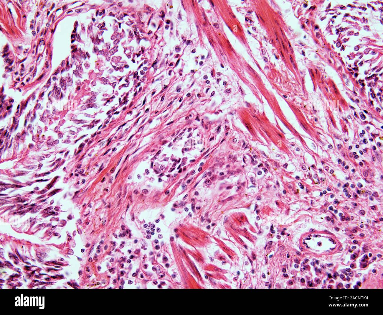 Lung cancer. Light micrograph of a section through lung tissue affected ...