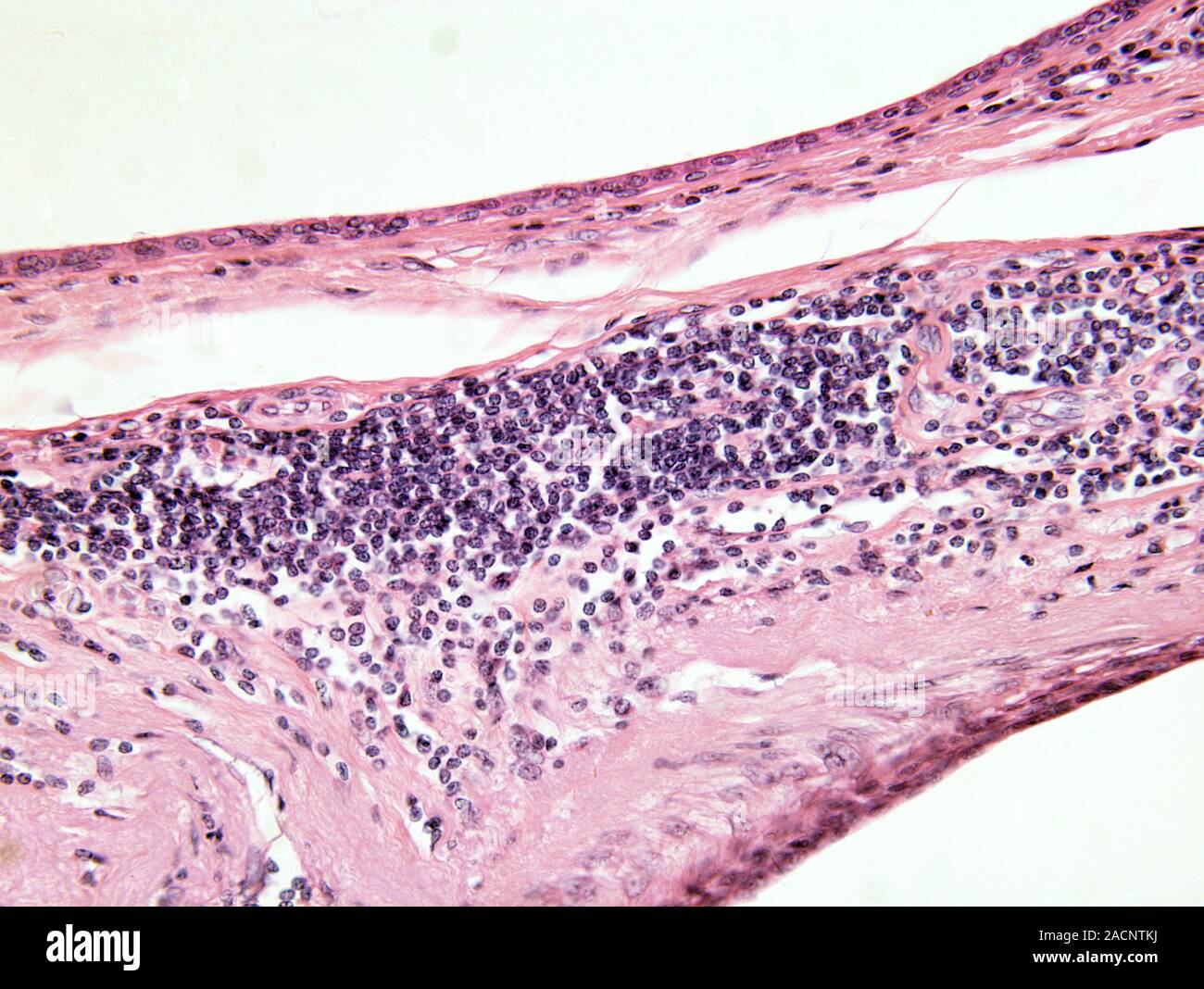 Oesophageal cancer. Light micrograph of a section through the cancerous ...