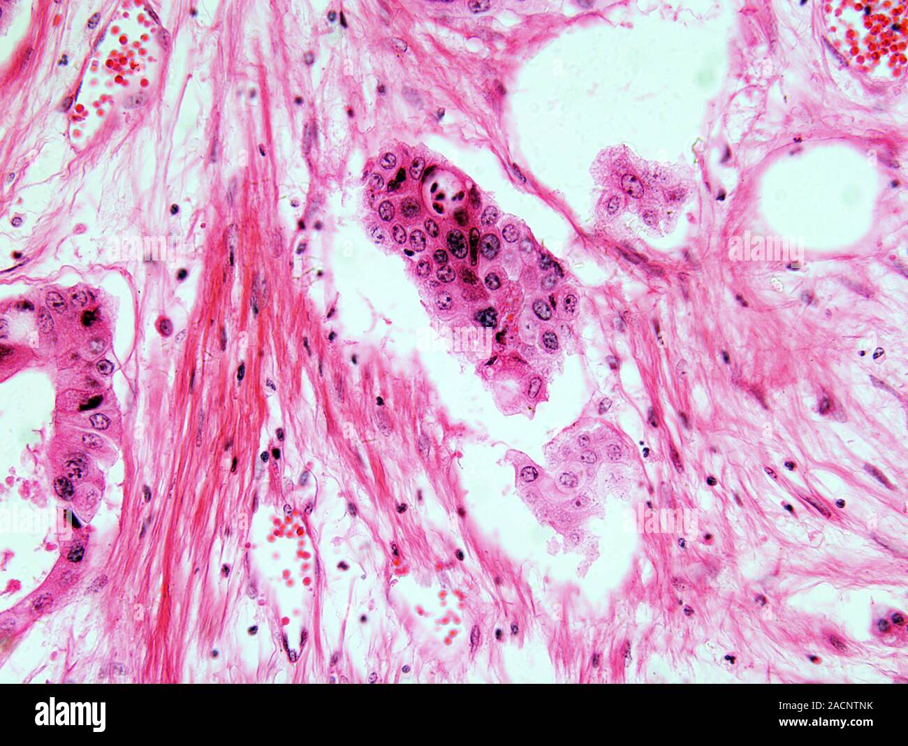 Liver cancer. Light micrograph of a section through a carcinoma (cancer ...