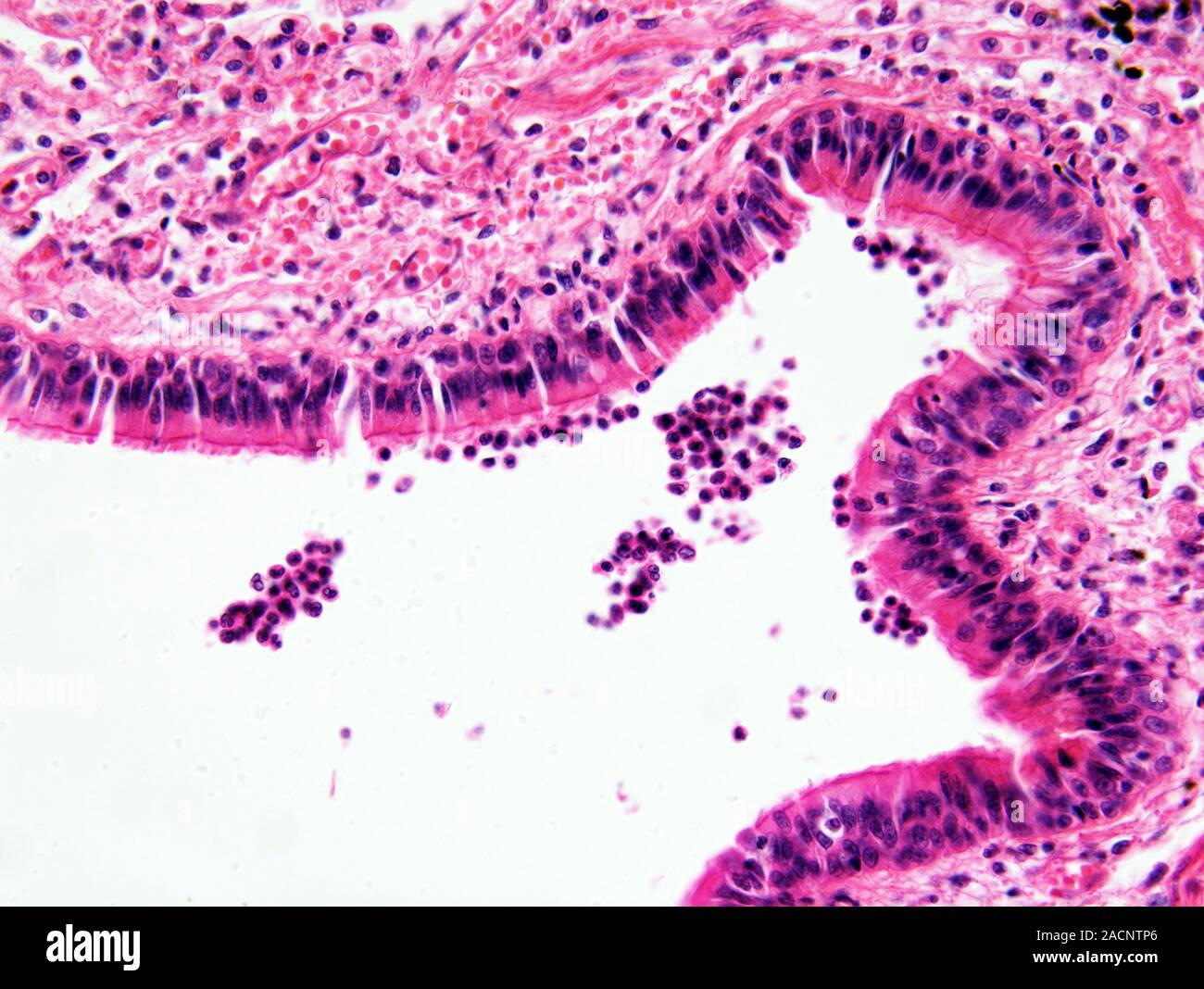 Emphysema. Light micrograph of a section through a lung with emphysema ...