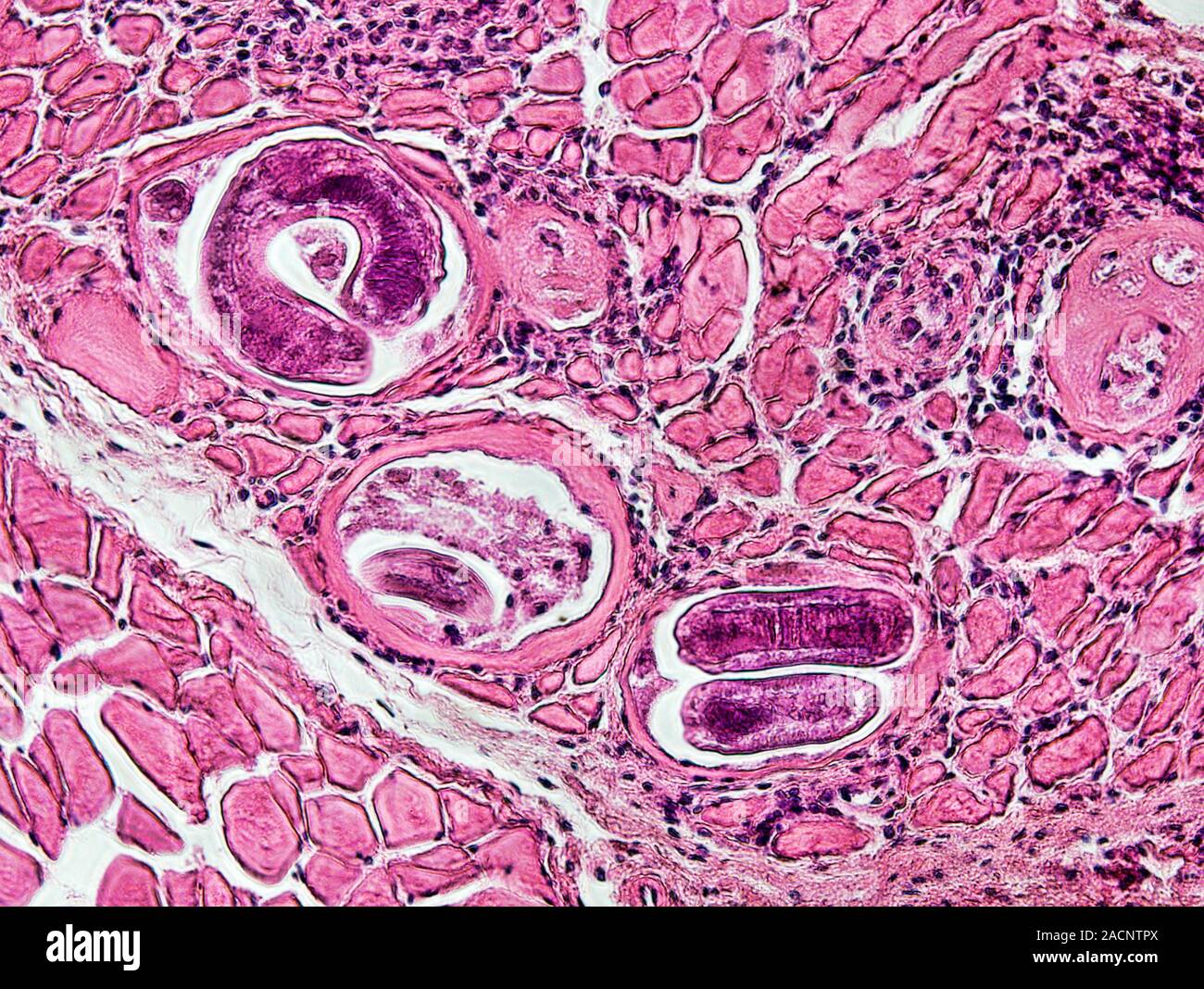 Worm infected tissue. Light micrograph of a section through human ...