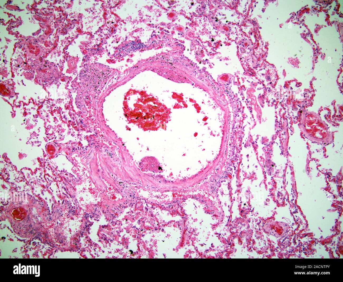 Tuberculosis, Coloured scanning electron micrograph (SEM) of a section through lung tissue ...