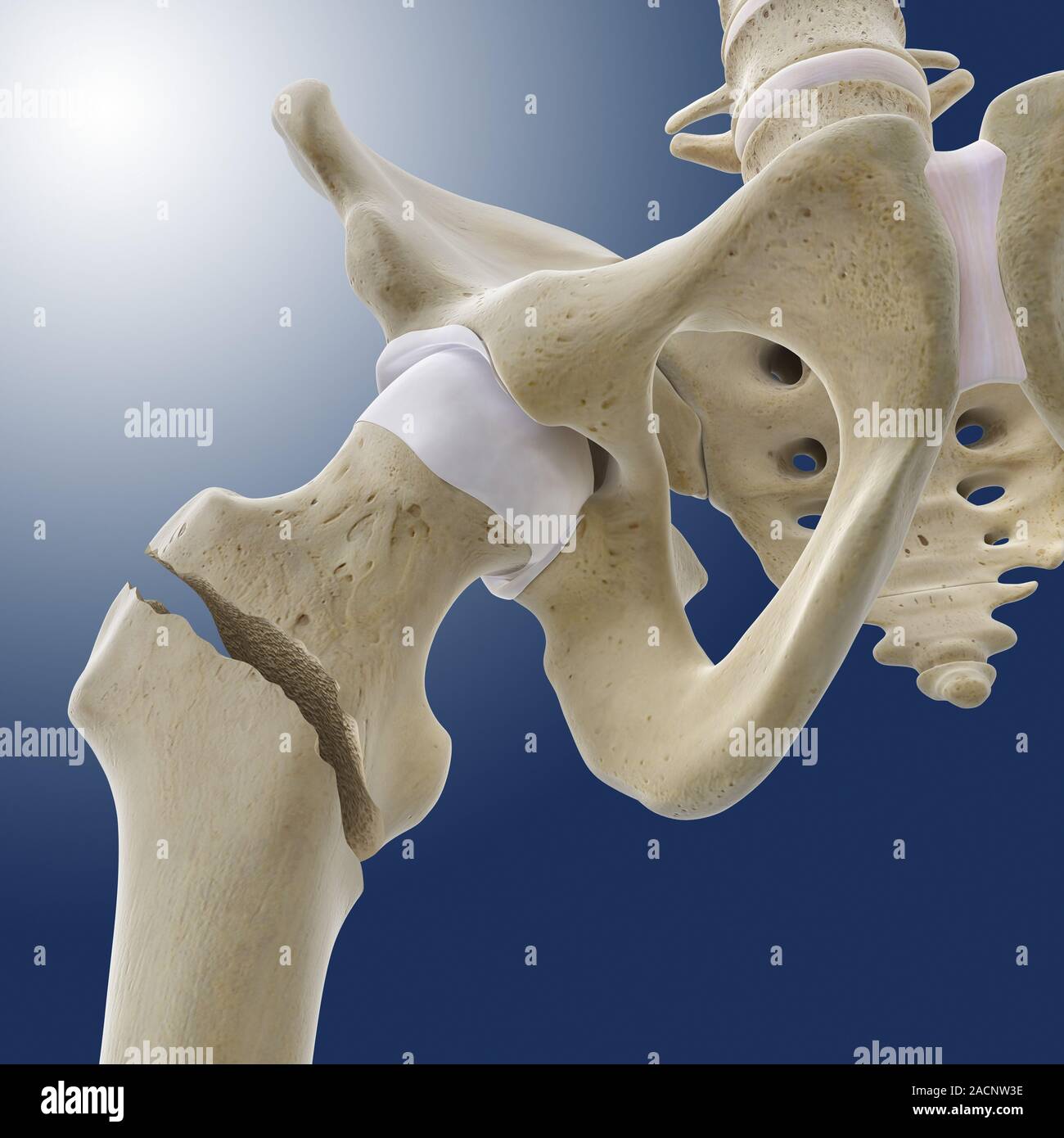 Fractured hip. Computer artwork of a fracture in the head of the femur ...