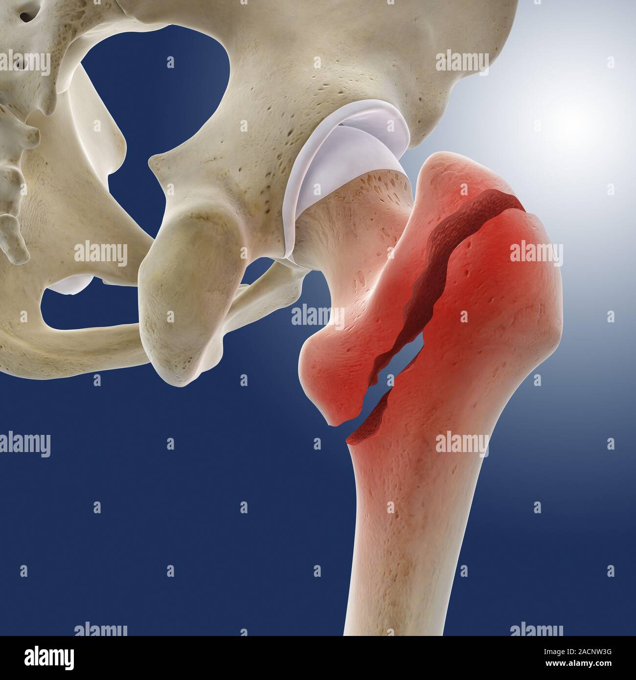 Fractured hip. Computer artwork of a fracture in the head of the femur ...