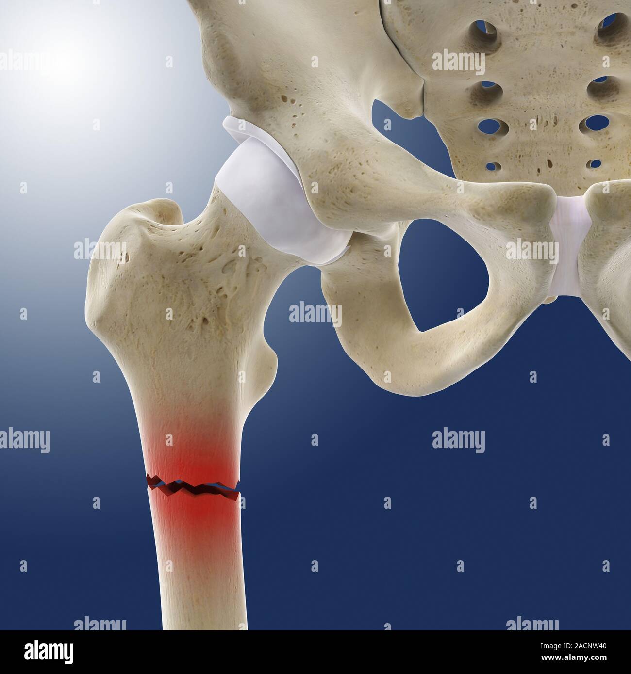 Fractured hip. Computer artwork of a fracture in the shaft of the femur ...