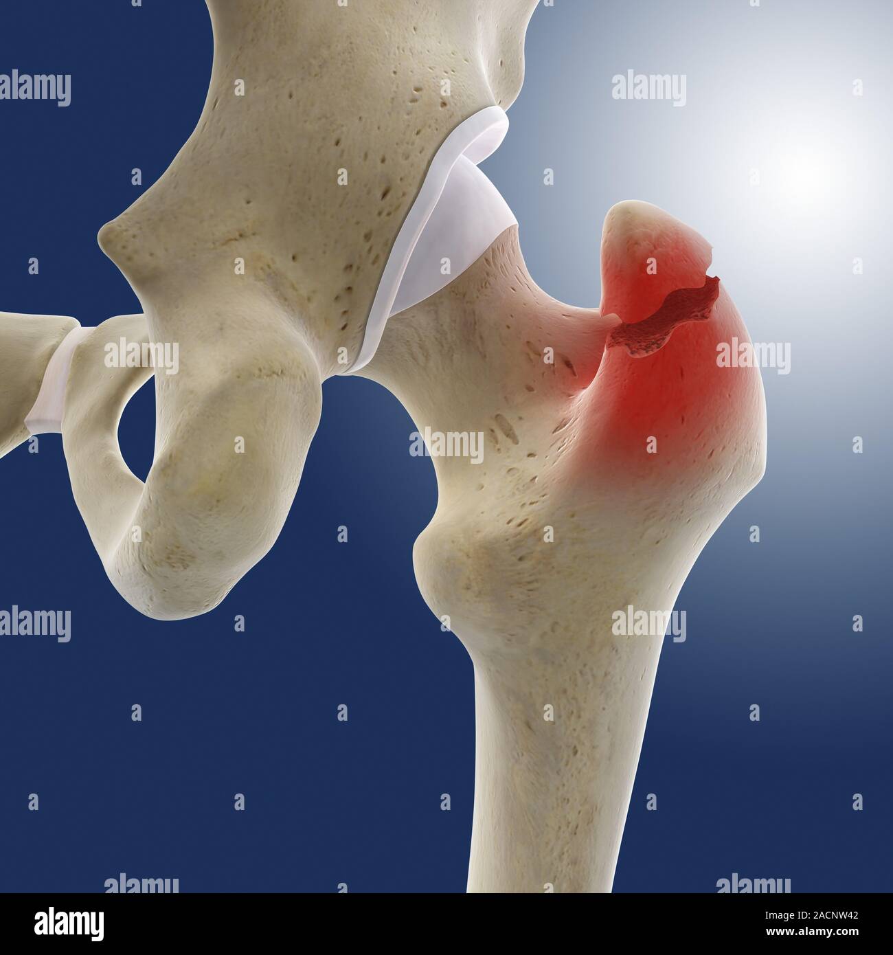 Fractured hip. Computer artwork of a fracture in the greater trochanter ...
