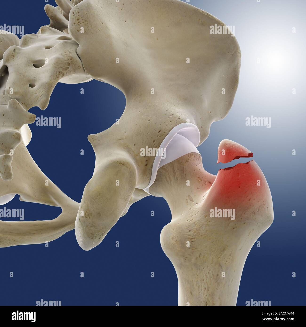 Fractured hip. Computer artwork of a fracture in the greater trochanter ...