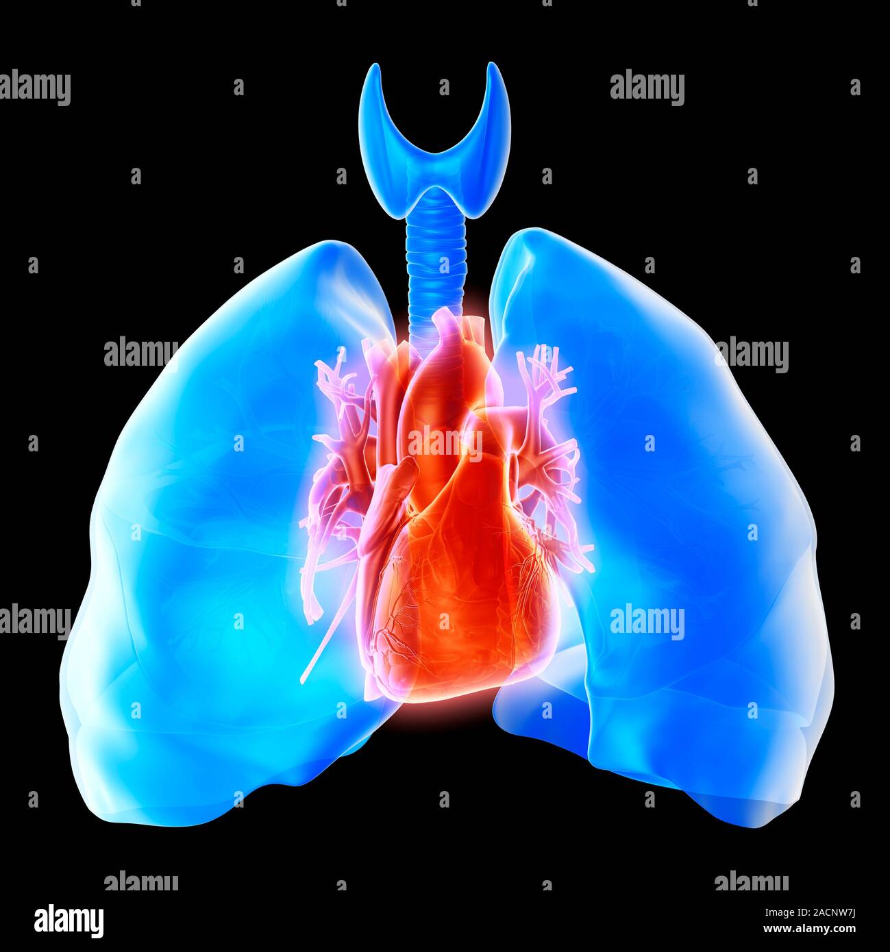 Pulmonary hypertension, computer artwork. Pulmonary hypertension is a ...