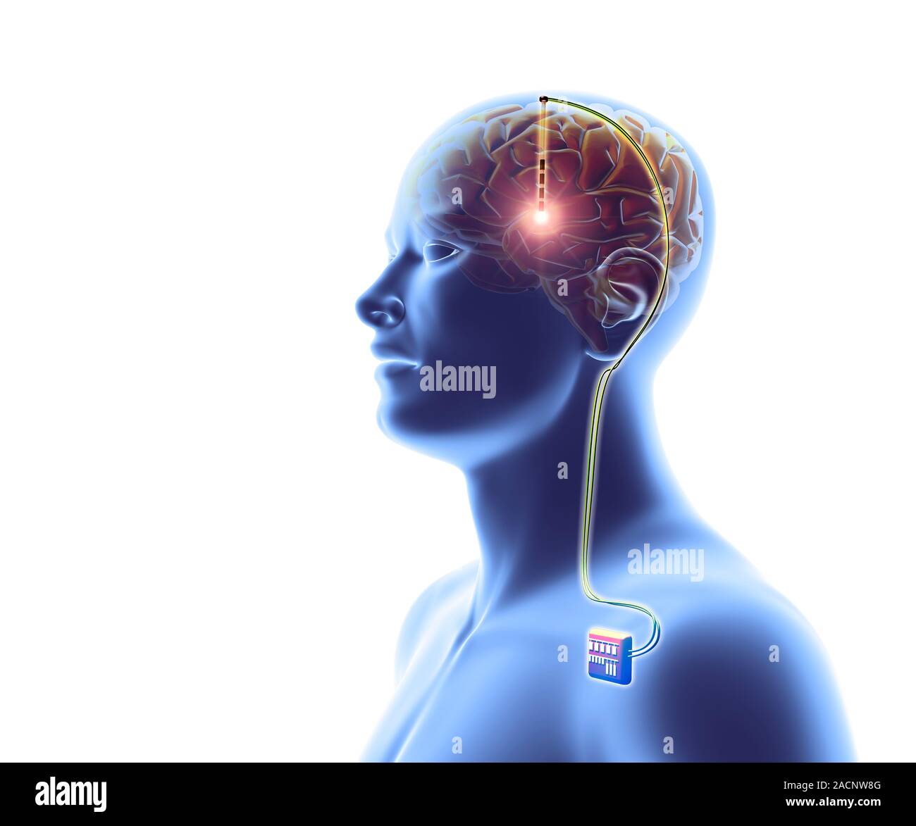 Deep brain stimulation, computer artwork. This neurosurgical treatment ...