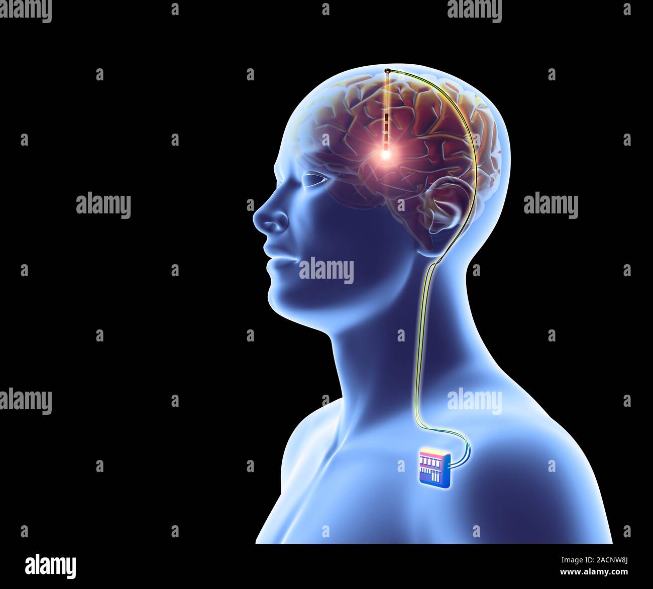 Deep brain stimulation, computer artwork. This neurosurgical treatment ...