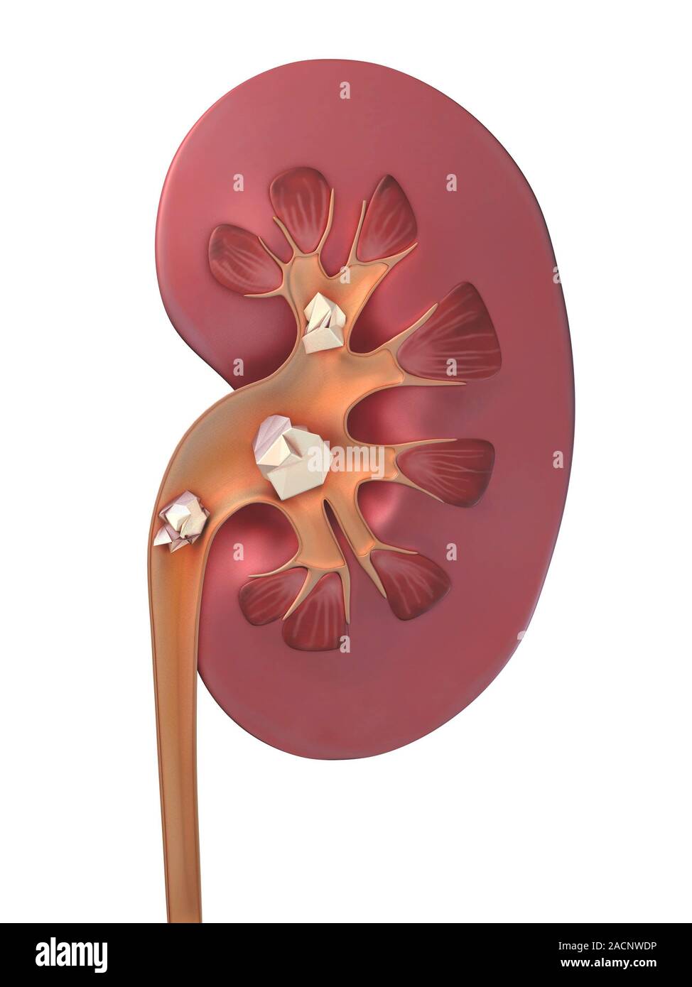 Kidney stones. Computer artwork showing a section through a human ...
