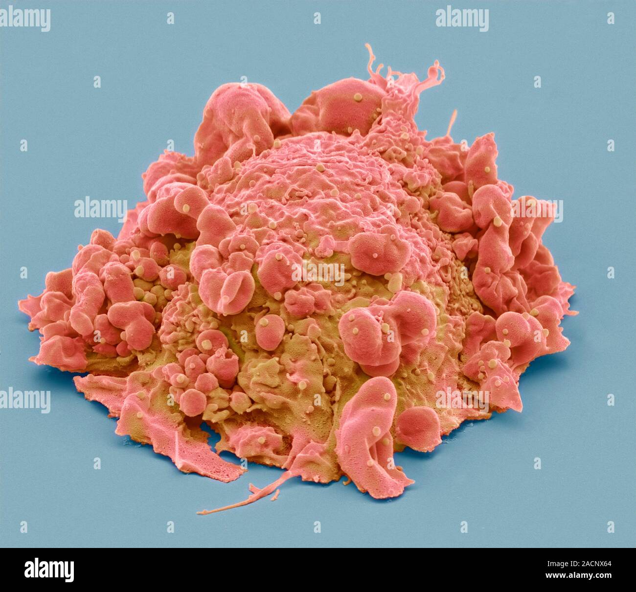 Colorectal Cancer Cell Coloured Scanning Electron Micrograph Sem Of