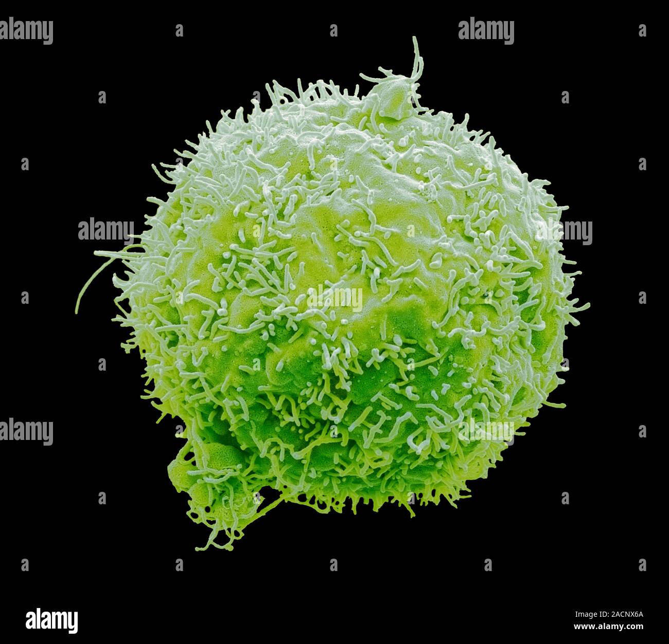 Liver cancer cell. Coloured scanning electron micrograph (SEM) of a ...