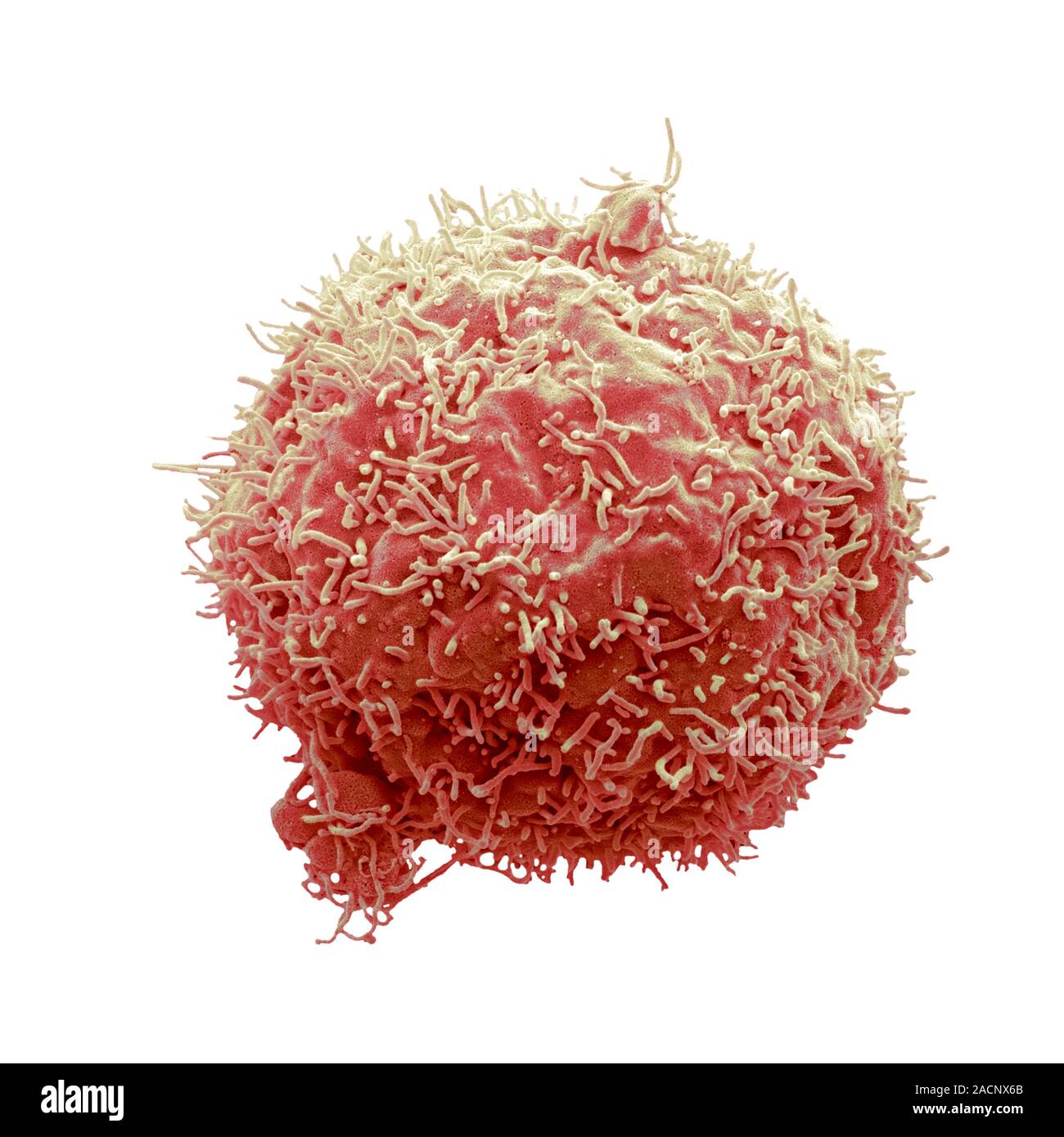 Liver cancer cell. Coloured scanning electron micrograph (SEM) of a ...
