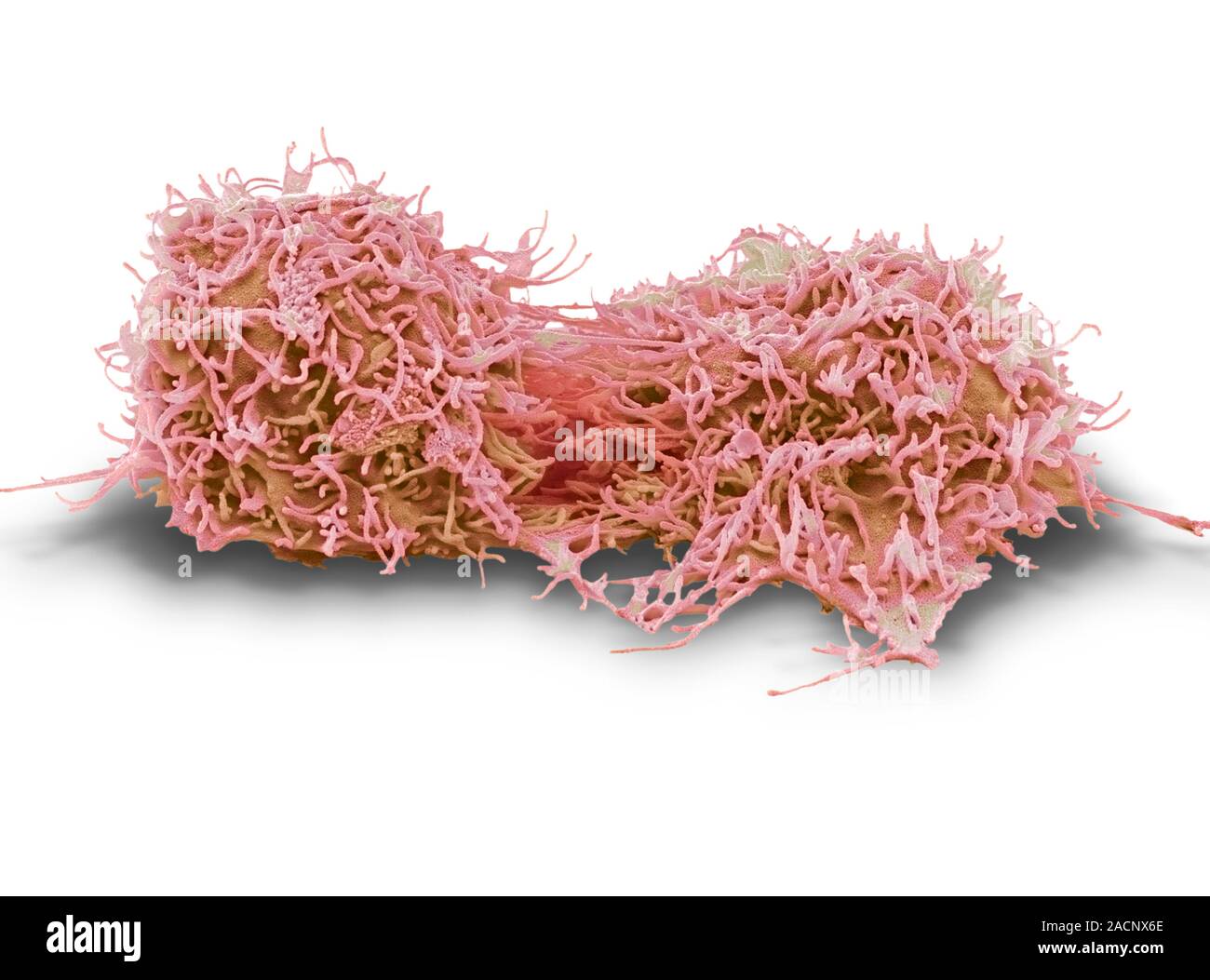 Dividing liver cancer cell. Coloured scanning electron micrograph (SEM ...