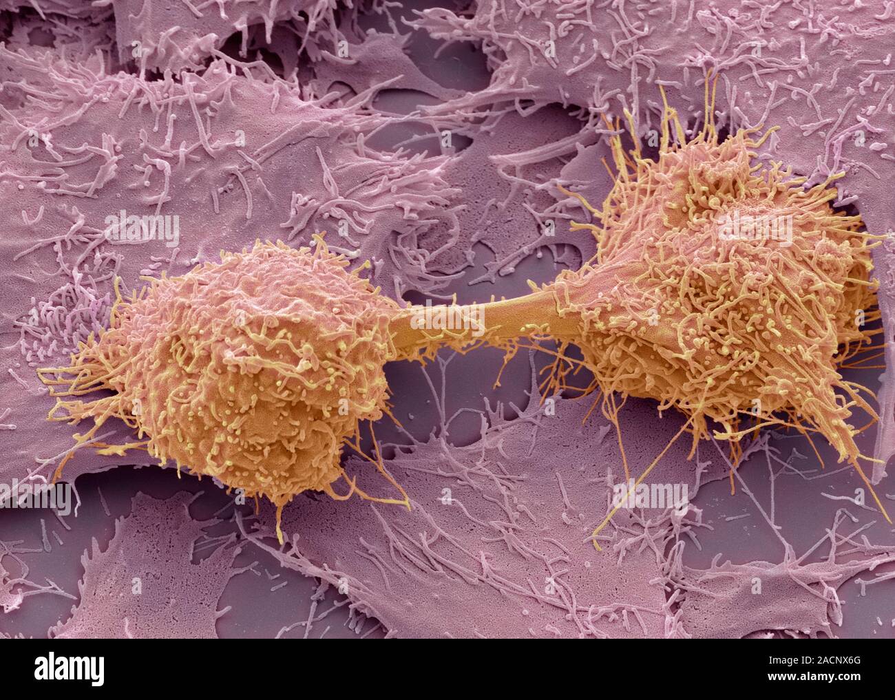 Dividing liver cancer cell. Coloured scanning electron micrograph (SEM ...
