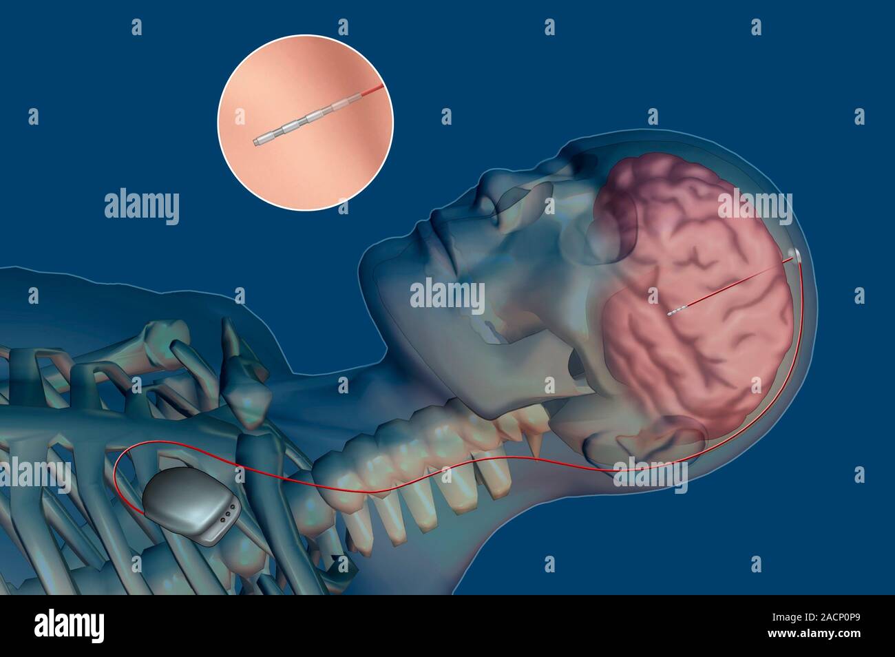 Brain pacemaker. Computer artwork showing a deep brain stimulation (DBS ...