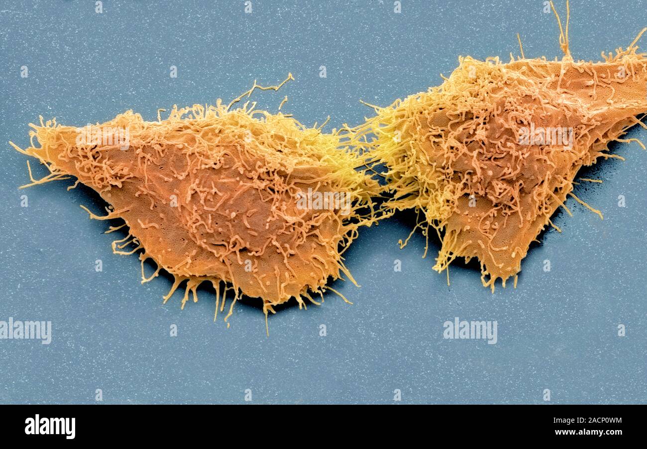 Dividing bone cancer cell. Coloured scanning electron micrograph of an ...
