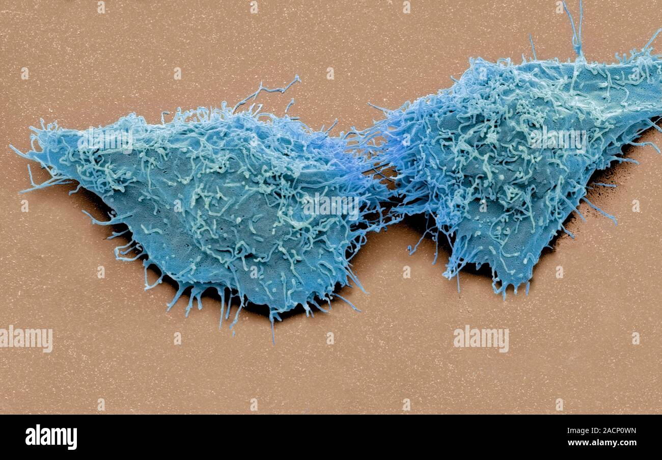 Dividing bone cancer cell. Coloured scanning electron micrograph of an ...