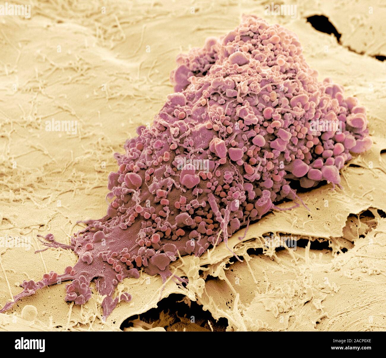 Bone cancer cell. Coloured scanning electron micrograph of an ...